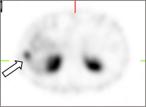Somatostatin Receptor Scintigraphy Somatostatin Receptor Scintigraphy