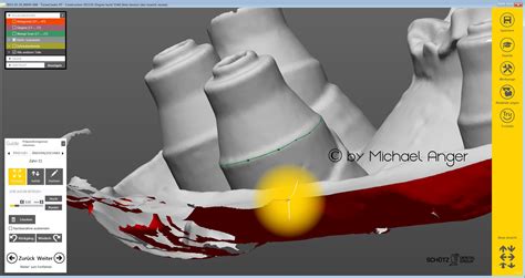 A New Exocad Modellation Implants Individual Screwchannels DENTALLIGENT Blog