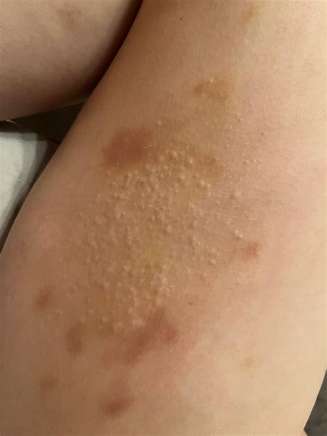 Very Itchy Bumps On Thigh Rdermatologyquestions