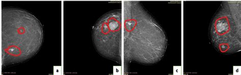 Examples Of Dataset Annotation For Bi Rads 4 A Cc View Of