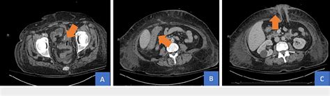 Figure 1 From A Case Report Of Necrotizing Neutrophilic Dermatosis A