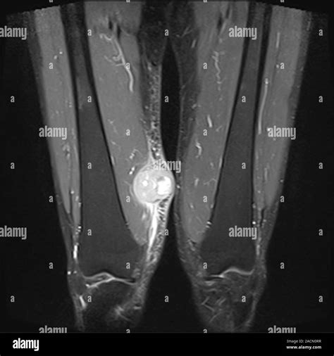 Mri Magnetic Resonance Imaging Of A Malignant Tumour Sarcoma On The