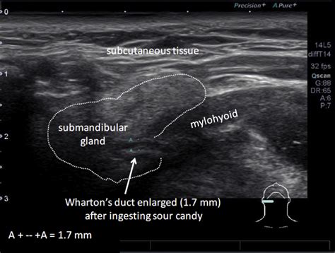 Ultrasound Guided Salivary Gland Techniques And Inter