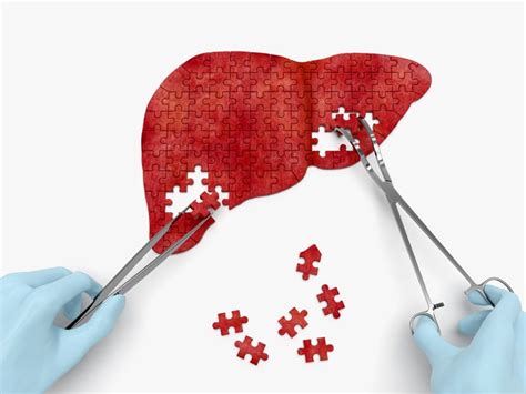 Liver Biopsy Purpose Procedure And Risks