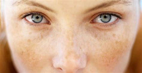 Everything You Need To Know About Freckles DermMedica Kelowna