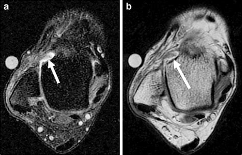 Anterolateral Impingement In A 13 Year Old Female Gymnast With Ankle