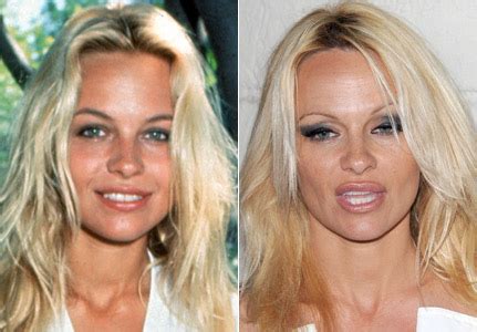 Pamela Anderson Before Plastic Surgery