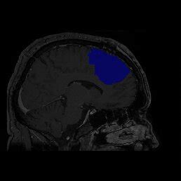 ROI Overlay Plot Showing Patient 2 S Binary Mask Overlaid Onto Their