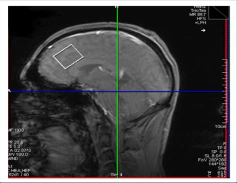 Position Of The Anterior Cingulate Cortex ACC In Human Brain Where Download Scientific