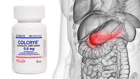 Colchicine Promising For Autoimmune Pancreatitis Medpage Today