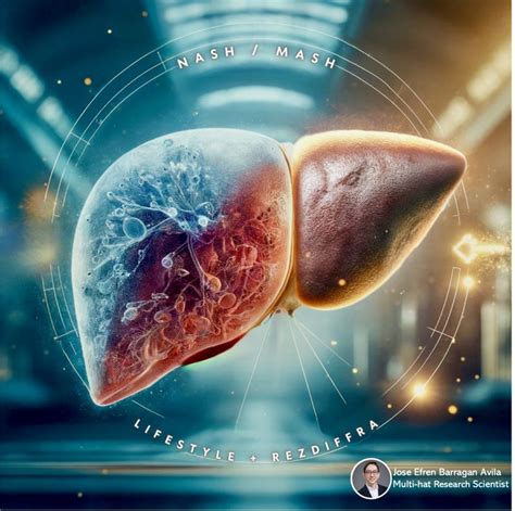 Rezdiffra Approved For Nashmash Treatment Jose Efren Barragan Avila