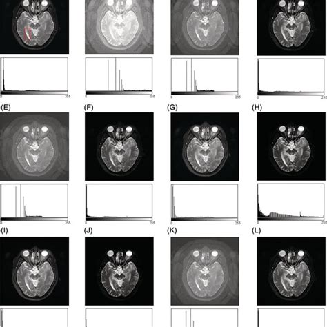 Lung Ct Image Histogram Equalization Result A Original Image B