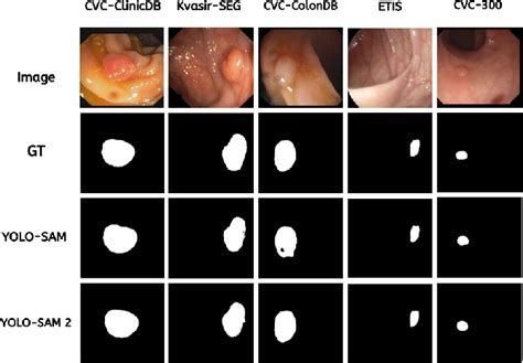 Self Prompting Polyp Segmentation In Colonoscopy Using Hybrid Yolo Sam