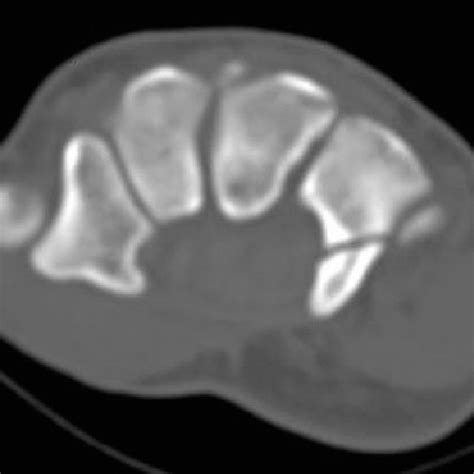 Pdf Return To Play After Hook Of Hamate Excision In Baseball Players