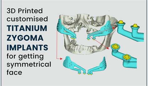 3D Printed Customized Titanium Zygoma Implants For Getting A