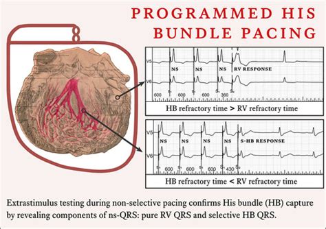 Programmed His Bundle Pacing Circulation Arrhythmia And