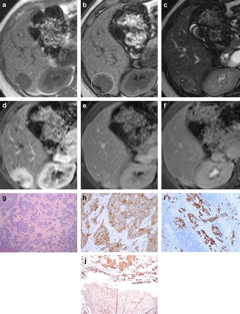 Figure 2 From Current Update On Combined Hepatocellular Cholangiocarcinoma Semantic Scholar