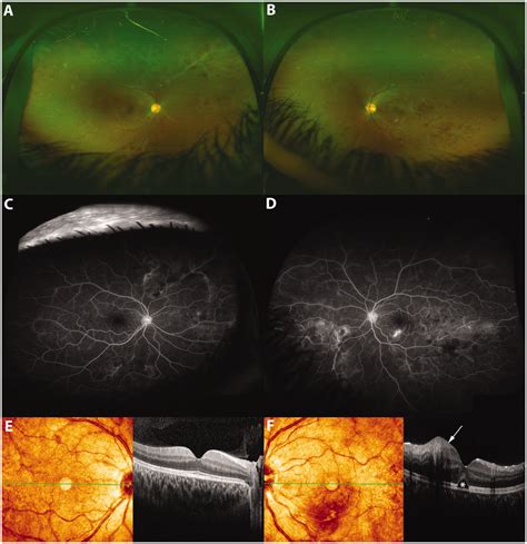 Clinical And Multimodal Findings In An 18 Year Old Woman With