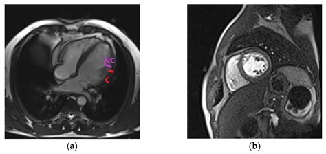 The Rare Condition Of Left Ventricular Non Compaction And Reverse