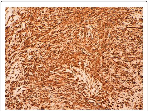Schwannoma Imunohistochemical Staining With Vimentin Download