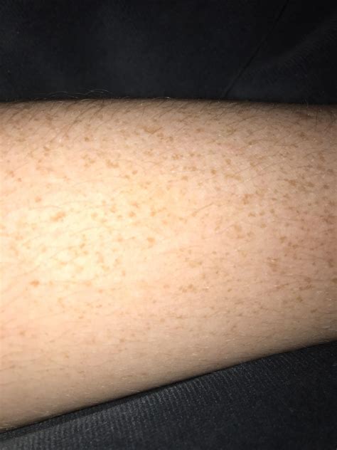 Chicken Pox Looks Like Small Dots And Rashes On The Skin I Dont Have It These Are My Freckles
