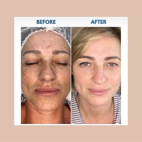 Sciton Bbl Laser Treatment In London