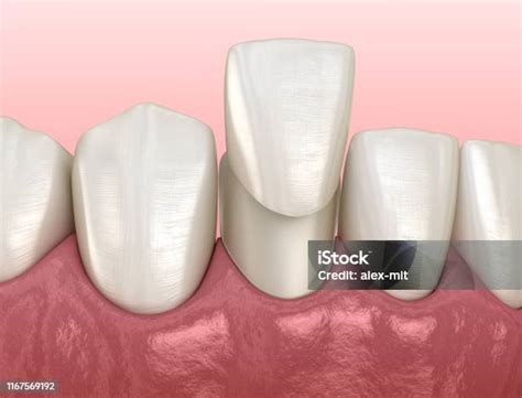 측면 절개를 통해 하악 베니어 설치 절차 의학적으로 정확한 치아 3d 일러스트레이션 치아 베니어에 대한 스톡 사진 및 기타 이미지 치아 베니어 이빨 자기 그릇