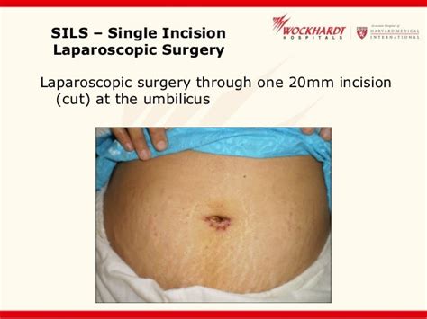 Single Incision Laparoscopic Surgery