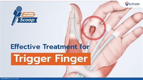 Effective Treatment for Trigger Finger | Vejthani's Scoop - Vejthani ...