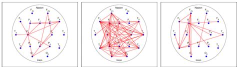 Sample Eeg Synchronization Graphs For Pre Ictal Ictal And Post Ictal