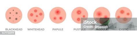 여드름 타입을 설정합니다 피부 여드름 블랙 헤드 및 얼굴 코미디언 여드름 피부 유형 블랙헤드 화이트헤드 구진 농포 낭성 및 결절성 0명에 대한 스톡 벡터 아트 및 기타