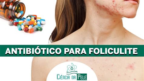 Qual Melhor Antibi Tico Contra Foliculite Youtube