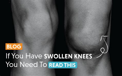 Knee Inflammation Swelling