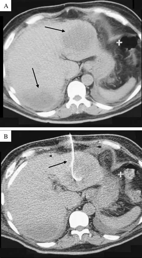 Computed Tomography A Axial Section Of Abdominal Computed Tomography