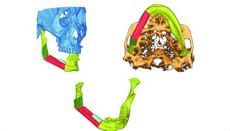 Mandible Reconstruction Download Scientific Diagram