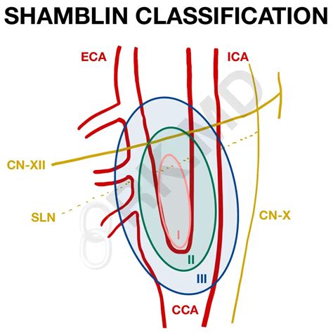 Shamblin Classification Of Carotid Body Tumors Rk Md