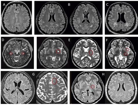 Asymptomatic Cerebral Small Vessel Disease In Adults With Low