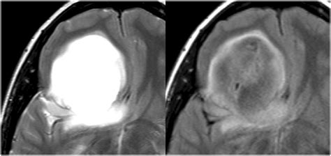 An Example Of T2 Flair Mismatch Sign A Patient With Idh Mutant