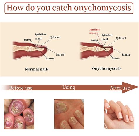 Fungal Nail Repair Liquid Pen Onychomycosis Paronychia Ant Fungal Nai