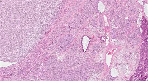 Epithelial Myoepithelial Carcinoma Of The Salivary Glands Ottawa