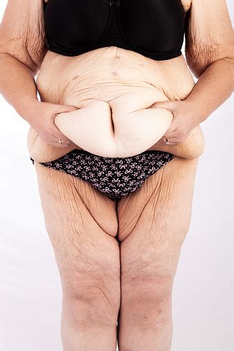 앞을 향하게 하 여 성숙한 여성의 과잉 배꼽 피부를 부 종 절제술 판 절제술 또는 앞치마 제거 및 내부 허벅지 감소 포스터와