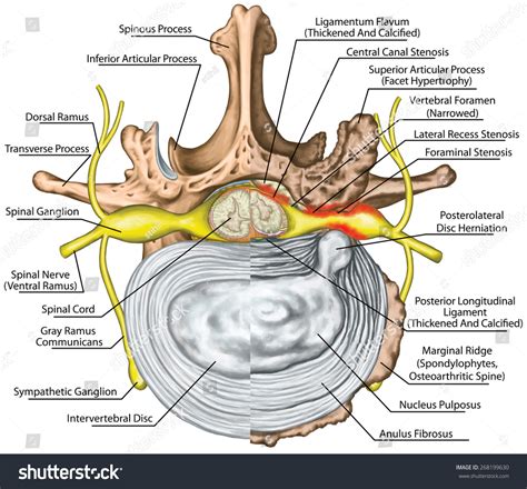 Stenosis Lumbar Disk Herniation Herniated Disc Stock Illustration