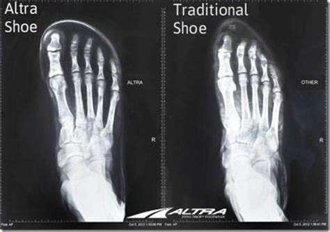 Your Feet In Wide Vs Narrow Shoes Great Visual From Altra Running