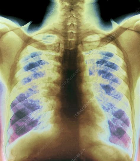 Sarcoidosis Of The Lungs X Ray Stock Image C0041446 Science
