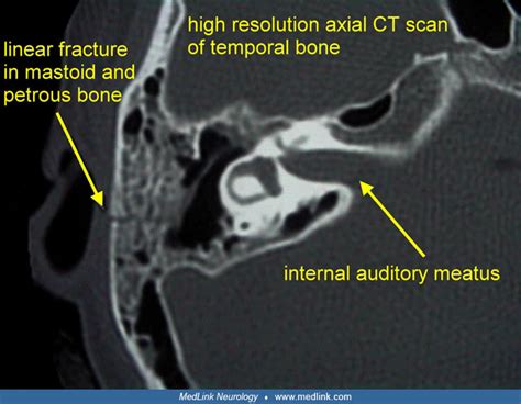 Petrous Temporal Bone Fracture