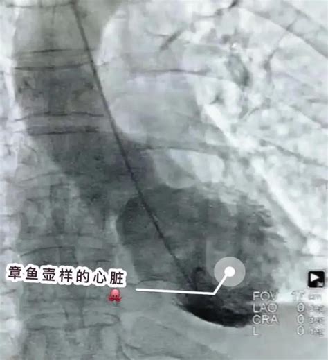 心真的會「碎」！女子整個心室突變「章魚壺」，原因竟是 每日頭條