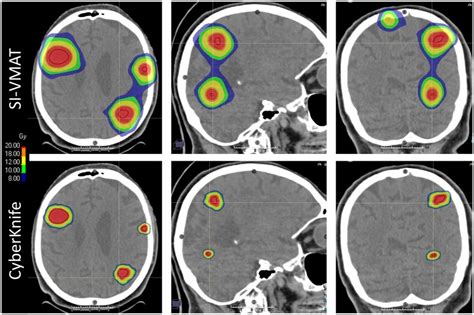 Single Isocenter Volumetric Modulated Arc Therapy Vs Cyberknife M6 For The Stereotactic