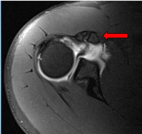Case Presentation For Arthroscopic Internal Fixation Of Coracoid Fracture Published In Journal
