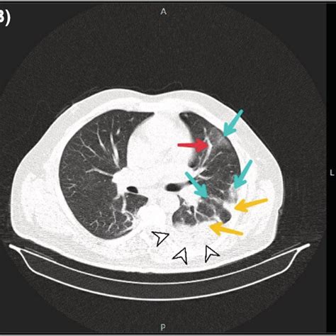 Parenchymal View Of The Spiral Chest Ct Scan At Admission A Nodule