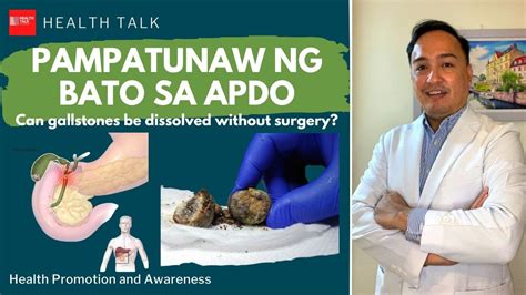 Pampatunaw Ng Bato Sa Apdo Can Gallstones Be Dissolved Without Surgery